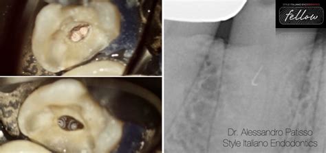 Management Of A Deep Bifurcation In A Mandibular First Premolar With Small Instrument Fractured