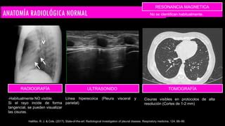 Comprehensive Overview Of Pleural Diseases Anatomy Physiology And