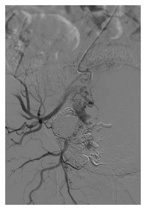 Concomitant Transarterial And Transvenous Embolization Of A Pelvic Arteriovenous Malformation