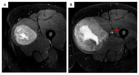 Surgical Management Of Desmoid Tumors—patient Selection Timing And