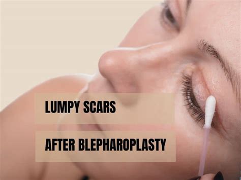 Scars After Upper Blepharoplasty
