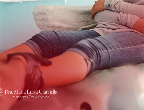 Varizes Reticulares Precisam De Tratamento Dra Maria Luisa