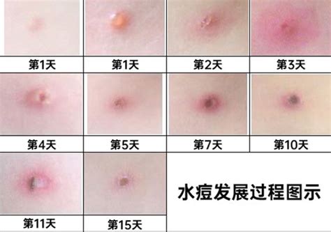 注意：水痘进入高发期，全员做好战 痘”准备！