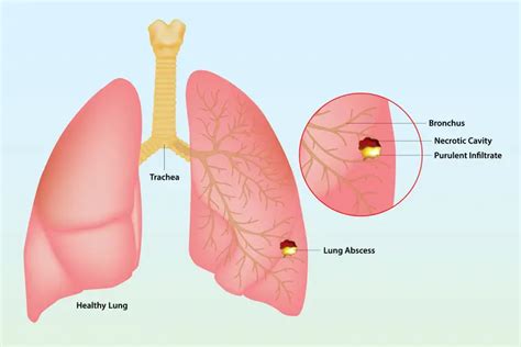 Lung Abscess Symptoms Causes Diagnosis Treatment