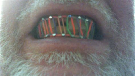 Wired Shut For How Many Weeks Rtmj