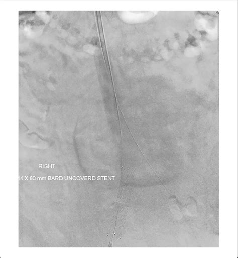 Pelvic Venogram Shows A 14 Mm × 80 Mm Venovo Venous Stent Red Arrow Download Scientific