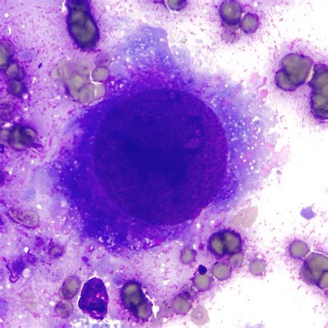 Giant Cell From Sarcoma Near Scapula Of A Cat Microscopic Cells Sarcoma Cell Biology