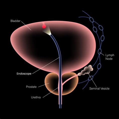 Bladder Stone Images Free Download On Freepik