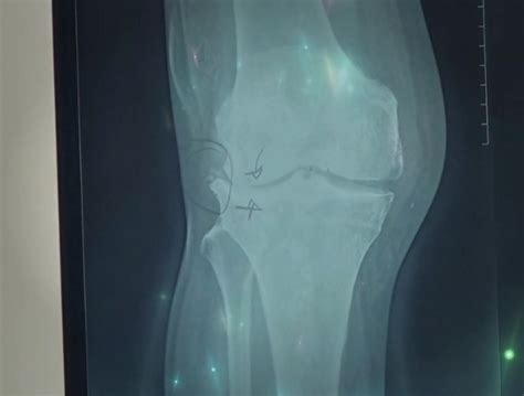 Por Iniciar Una Colocación De Prptesis De Rodilla Deformidad En Valgo