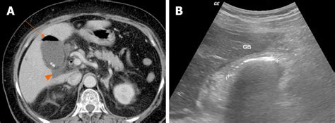 Fluid Collection Gallbladder Fossa At Nelida Huddleston Blog