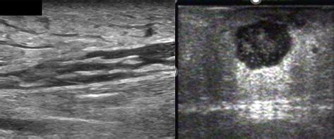 Point Of Care Ultrasound Differentiating Cellulitis Vs Abscess