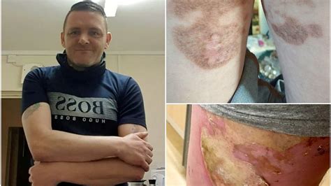 Russells Hall Hospital Patient Wins Payout After Treatment Left Him