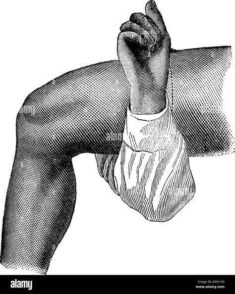 Amputation Of The Thigh By The Circular Method Skin Incision Vintage