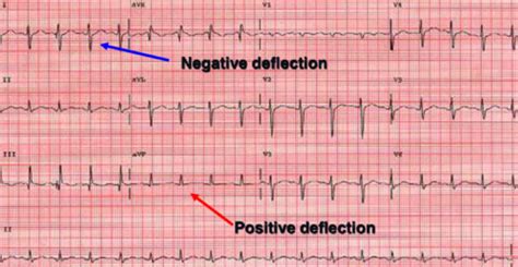 Ekg Waveforms Flashcards Quizlet