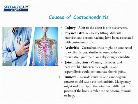 Ppt Costochondritis Powerpoint Presentation Free Download Id 11475742