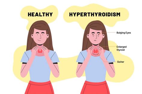Signs And Symptoms Of Hyperthyroidism Include