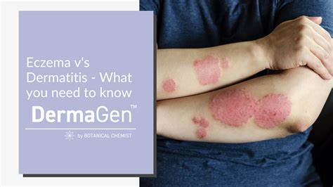 Eczema Vs Dermatitis What You Need To Know Dermagen By Botanical Chemist