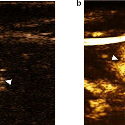 A The Imaging Example Of Positive Lymph Node Which Showed Download Scientific Diagram
