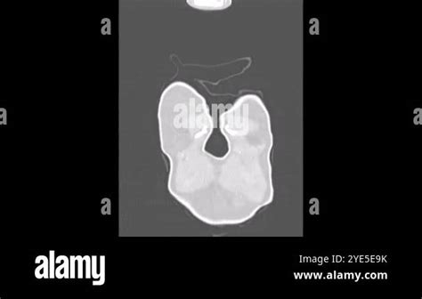 Hiatus Hernia Ct Scan Stock Videos And Footage Hd And 4k Video Clips