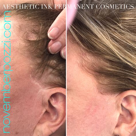 Corrective Makeup For Hypopigmentation Saubhaya Makeup