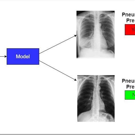 An Example Of Normal Cxr Vs Pneumonia Cxr Download Scientific Diagram