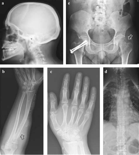 Biallelic Variants In The Ciliary Gene Tmem67 Cause Rhyns Syndrome Pmc