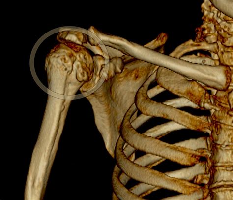 Clavicle Fractures Allman And Neer Classification Journal Of Advances In Radiology And