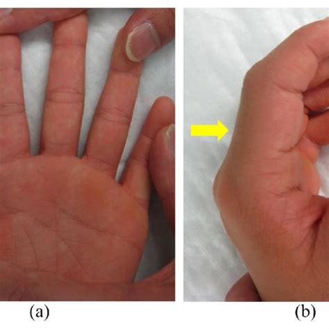 The Left Index Finger A B Showed Diffuse Soft Tissue Swelling Download Scientific Diagram