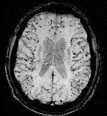 Amyloid Spells A Brain Mine — Neurologyresidents