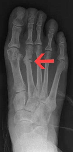 March Fracture Wikipedia