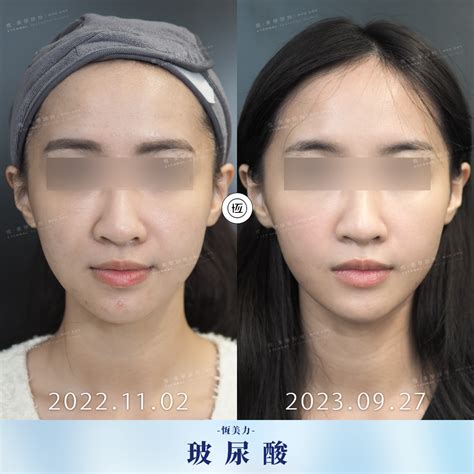 Teoxane緹奧希玻尿酸 瑞士頂級動態美學玻尿酸 動不動都美 恆美學