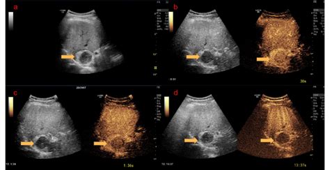 A Liver Mass Discovered During Physical Examination In A 30 Year Old