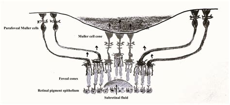 Central Foveal Bouquet Abnormalities Eyewiki