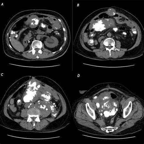 En Bloc Resection Specimen Of Heterogeneous Tumor With Attached Organs