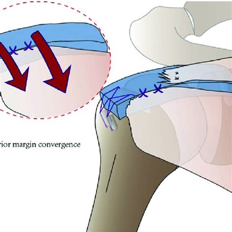 Posterior Margin Convergence May Increase The Postoperative