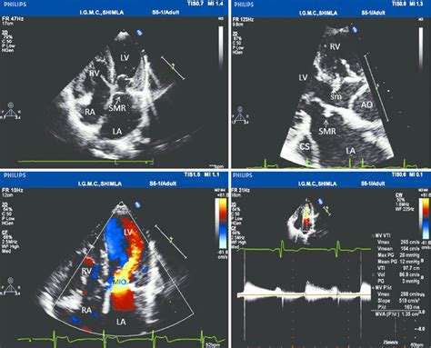 Transthoracic Echocardiogram Demonstrating Supramitral Ring Subaortic