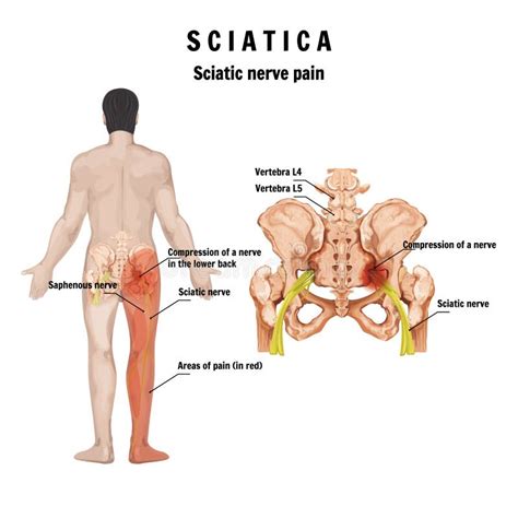 Sciaticasymptoms Causes Neuropathy Sciatic Nerve Illustration Of