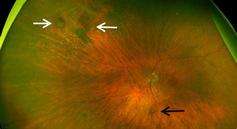 Optic Disc In Patients With Peripheral Retinal Tears Cia