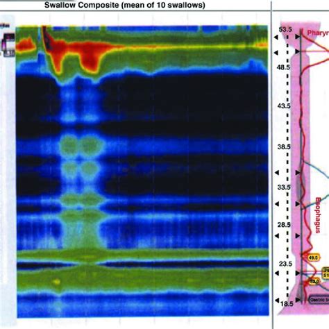 Esophagogram Showing A Dilated Tortuous Esophagus Consistent With