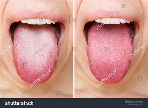 What Does A Healthy Tongue Look Like
