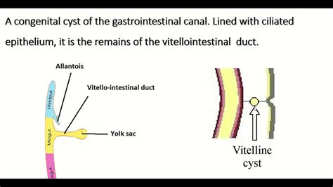 Omphalomesenteric Duct