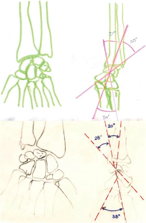 28 Years After Matti Risse Scaphoid Bone Surgery Asymptomatic “disi” Download Scientific