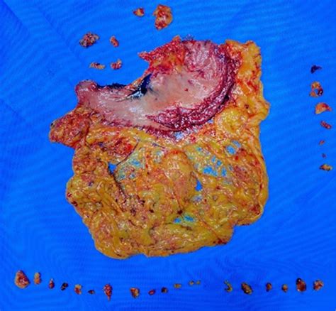The Figure Shows Lymph Node Sorting After Gastric Angle Cancer