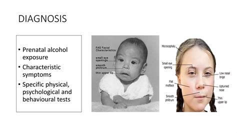Fetal Alcohol Syndrome Ppt Pptx