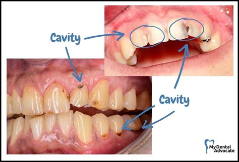 What Does A Cavity Look Like 20 Pictures Mda