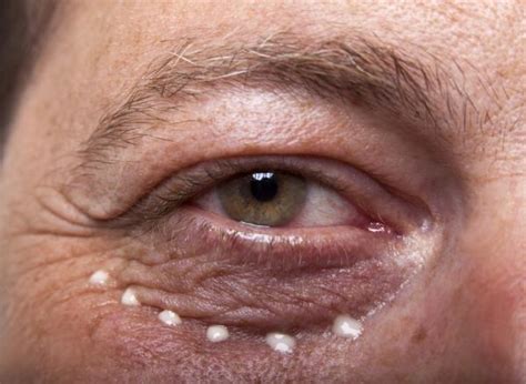 Cómo Eliminar Las Ojeras Hundidas Consejos Y Tratamientos