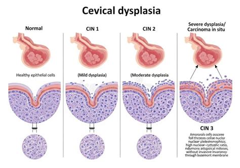 Diagram Illustrating Cervical Dysplasia Stages Four Stock Illustration