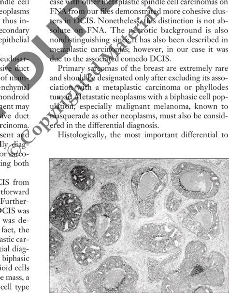 Excision Specimen Showing Solid And Cribriform Dcis With Luminal