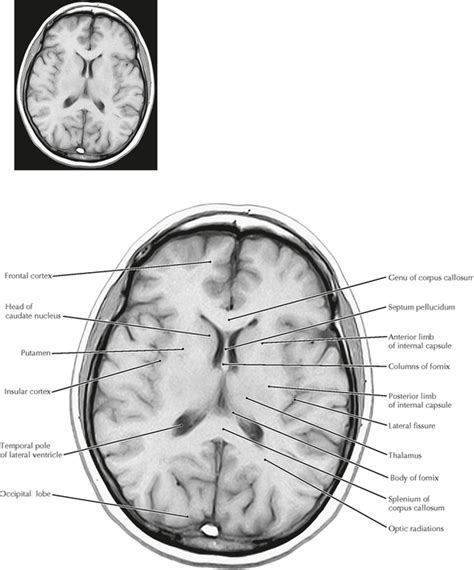 Basal Ganglia Axial