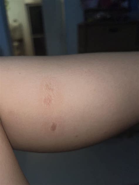 Is My Ringworm Healed It Has Already Flattened And Now It Has A